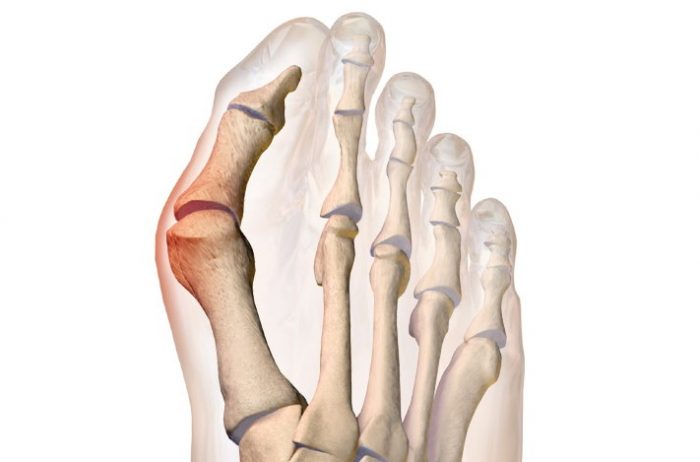 Bunion | Vancouver Foot Pain